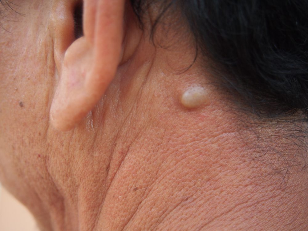At Arumeen we will perform epidermoid cyst removal in any parts of the body